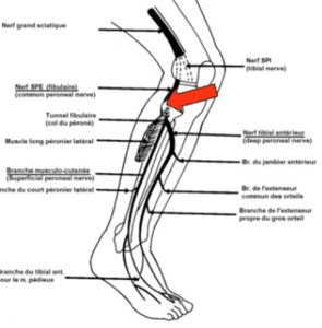 Compression du nerf fibulaire (SPE) au col du péroné - Dr Garrigues ...